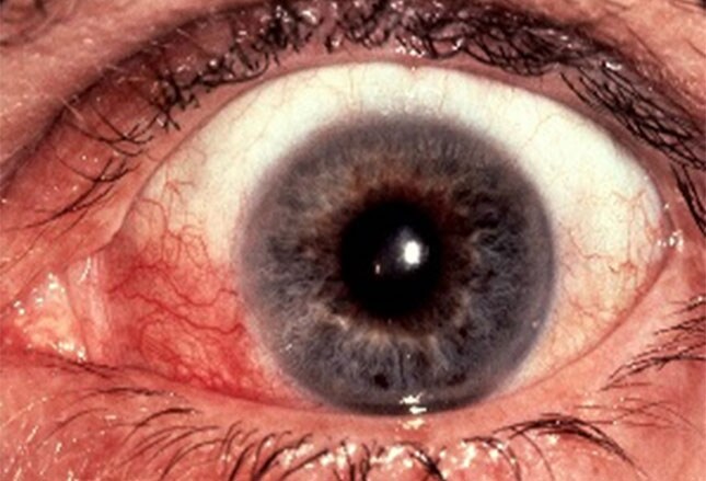 Rheumatoid Arthritis: In and Out of the Joint