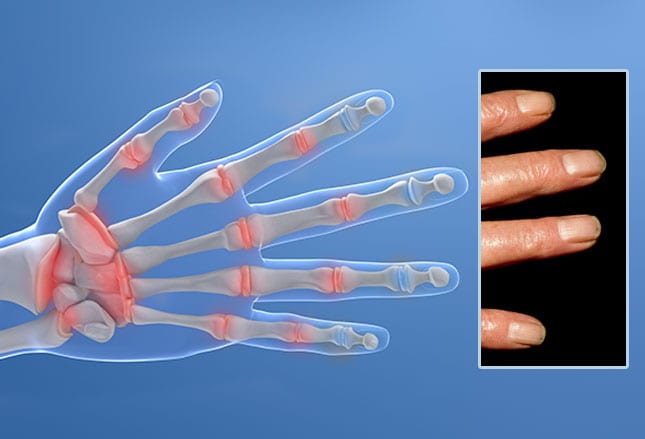 Rheumatoid Arthritis: In and Out of the Joint