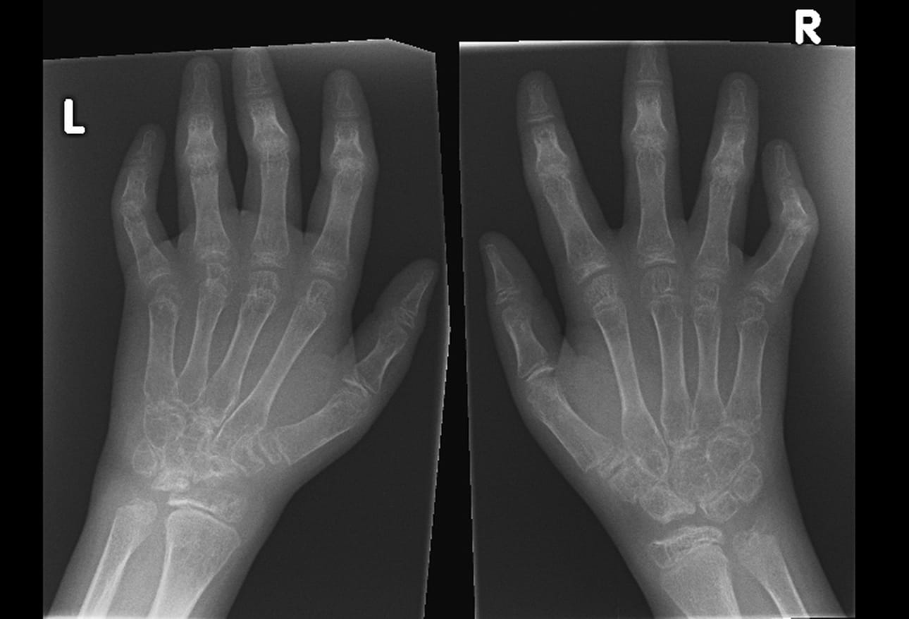Rheumatoid Arthritis: In and Out of the Joint