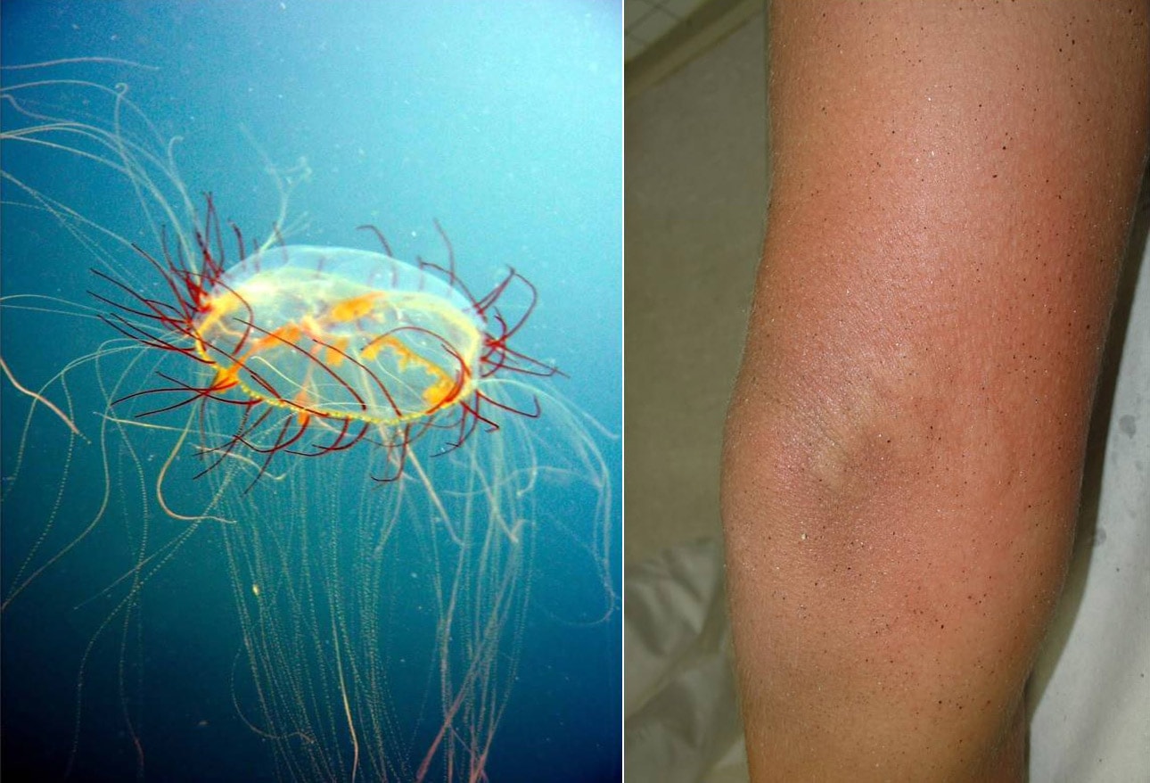 Scuba Diving Injuries and Underwater Hazards