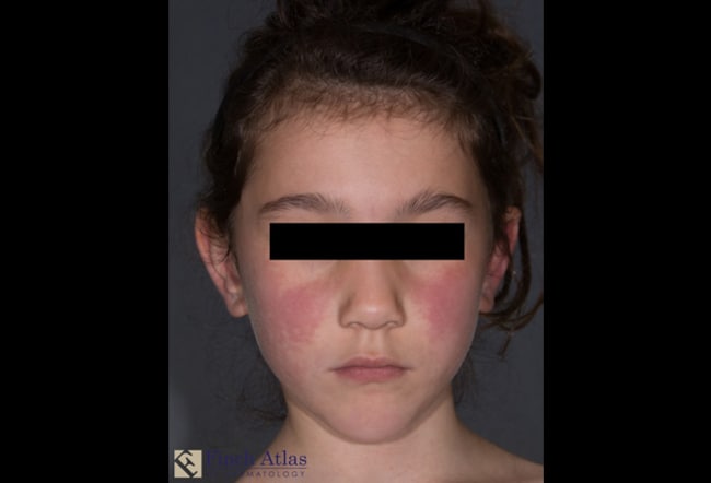 Eight Skin Rashes You Need to Know