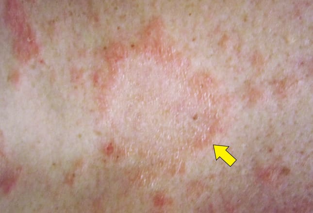 Eight Skin Rashes You Need to Know