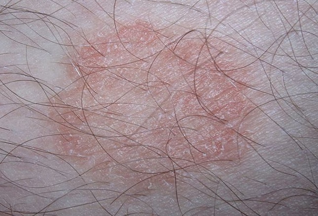 12 Rashes You Need to Know: Common Dermatologic Diagnoses