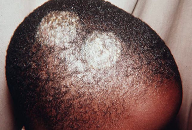 12 Rashes You Need to Know: Common Dermatologic Diagnoses