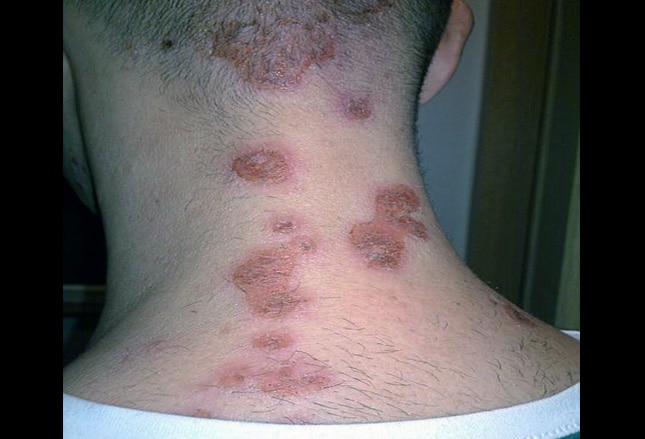 12 Rashes You Need to Know: Common Dermatologic Diagnoses