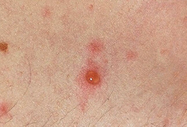 14 Rashes You Need to Know: Common Dermatologic Diagnoses