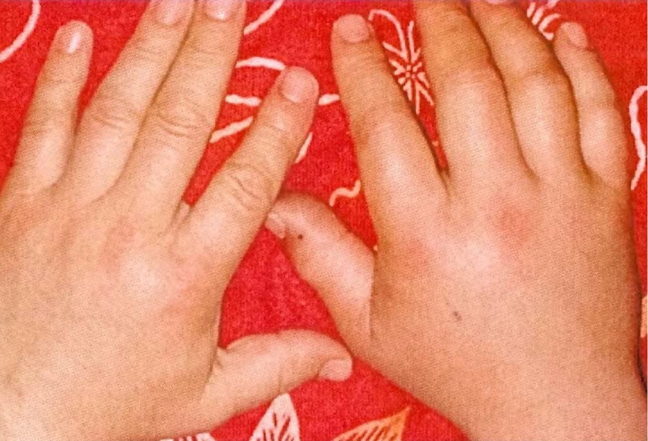 Snake Envenomations: More Than Just a Bite