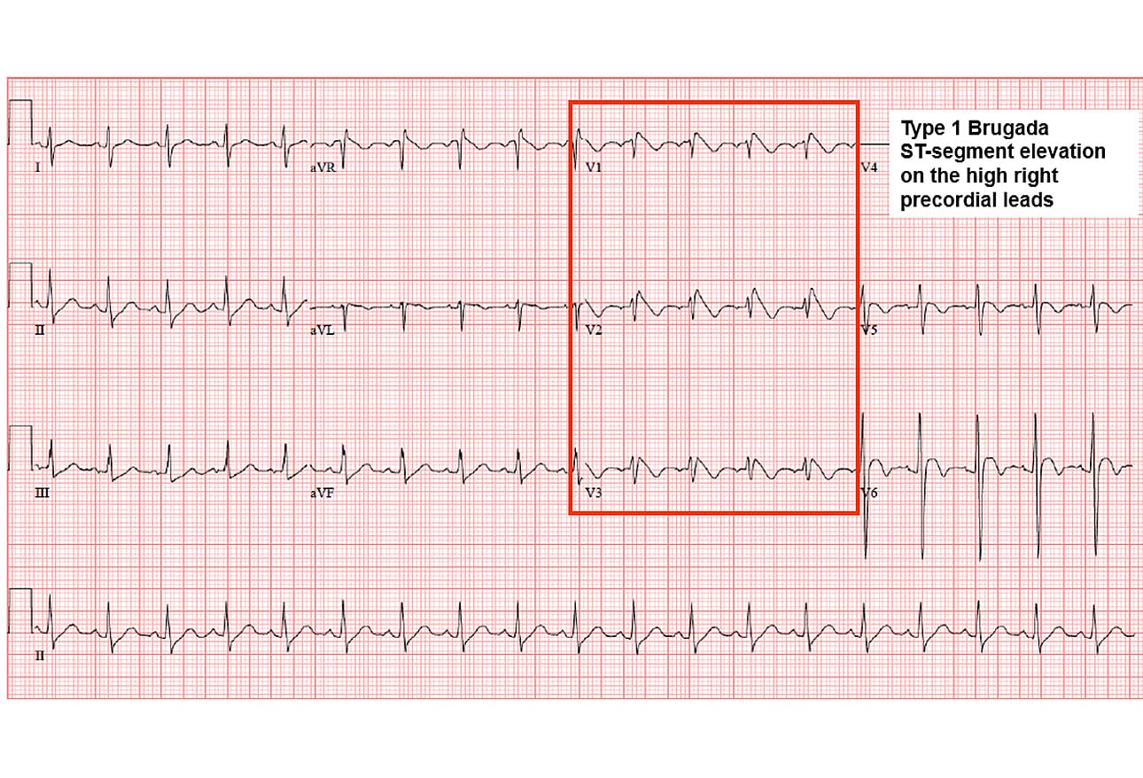 Sudden Cardiac Death