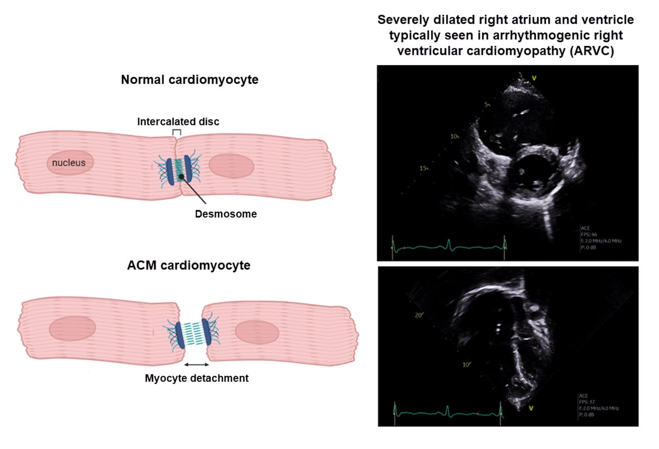 Sudden Cardiac Death