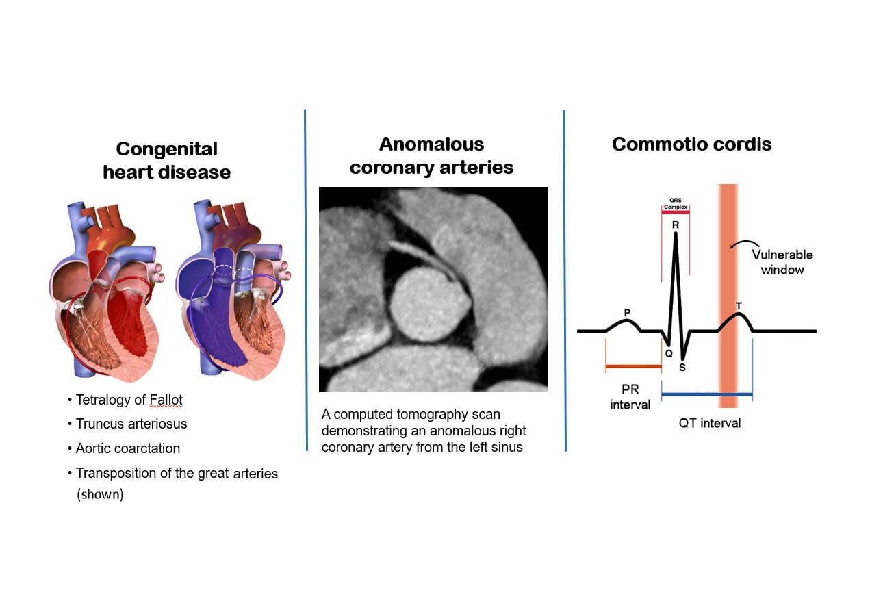 Sudden Cardiac Death