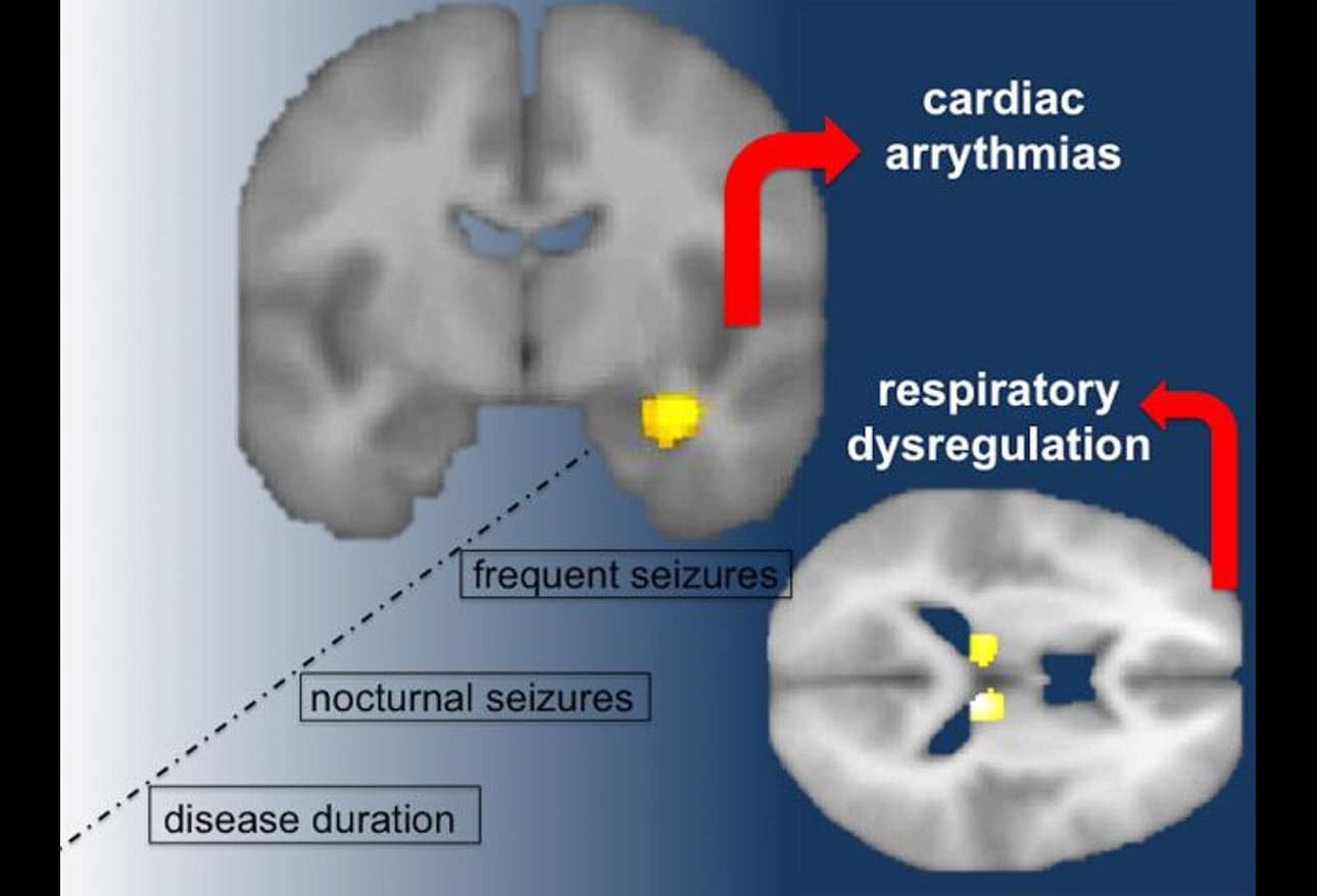 Sudden Cardiac Death