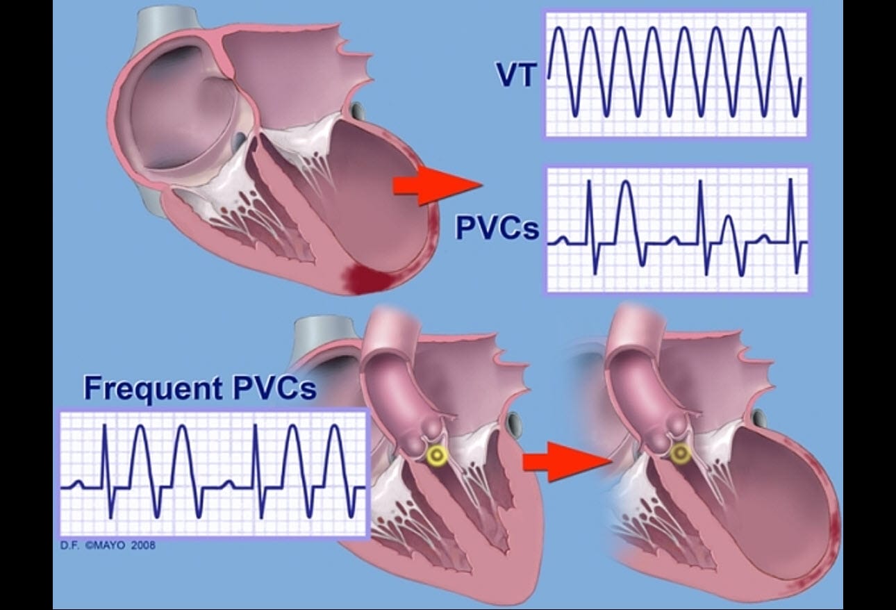 Sudden Cardiac Death