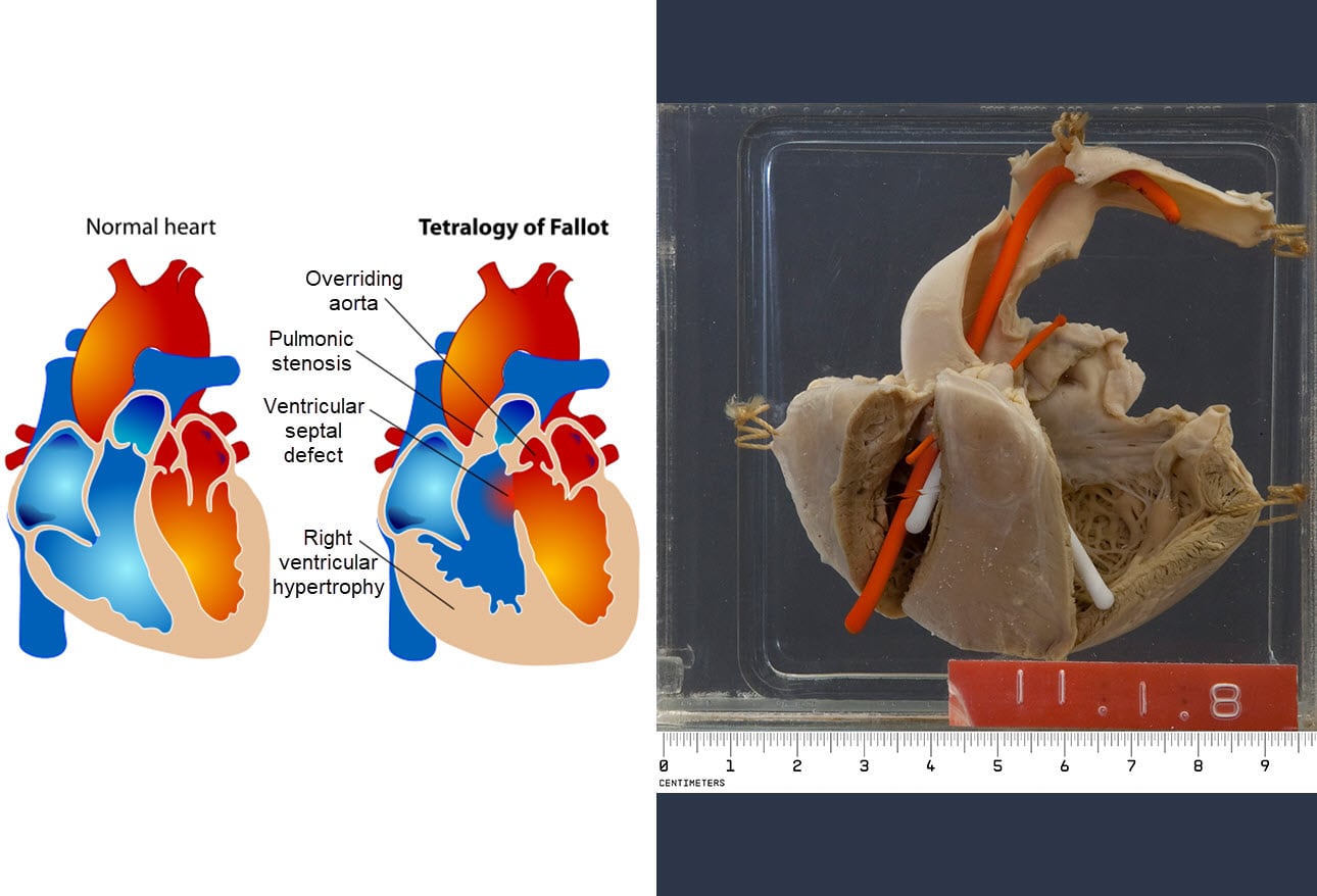 Sudden Cardiac Death