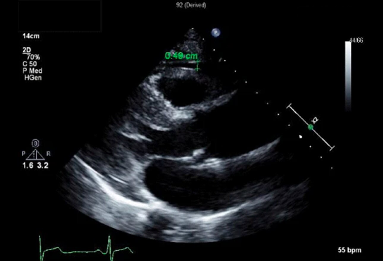 Sudden Cardiac Death in Athletes