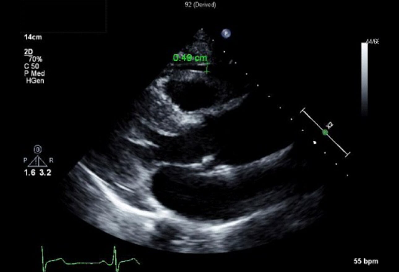 Sudden Cardiac Death in Athletes