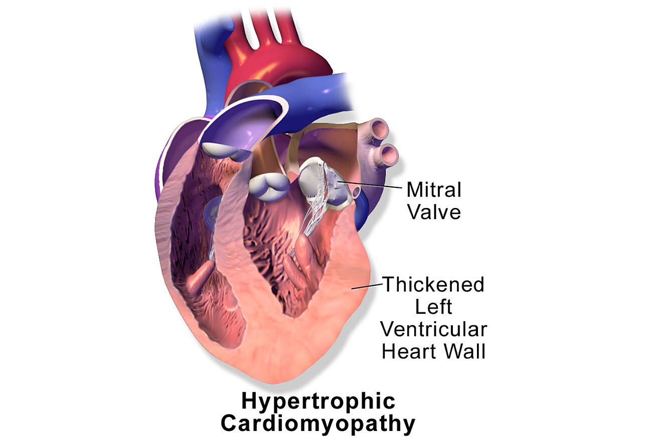 Sudden Cardiac Death in Athletes