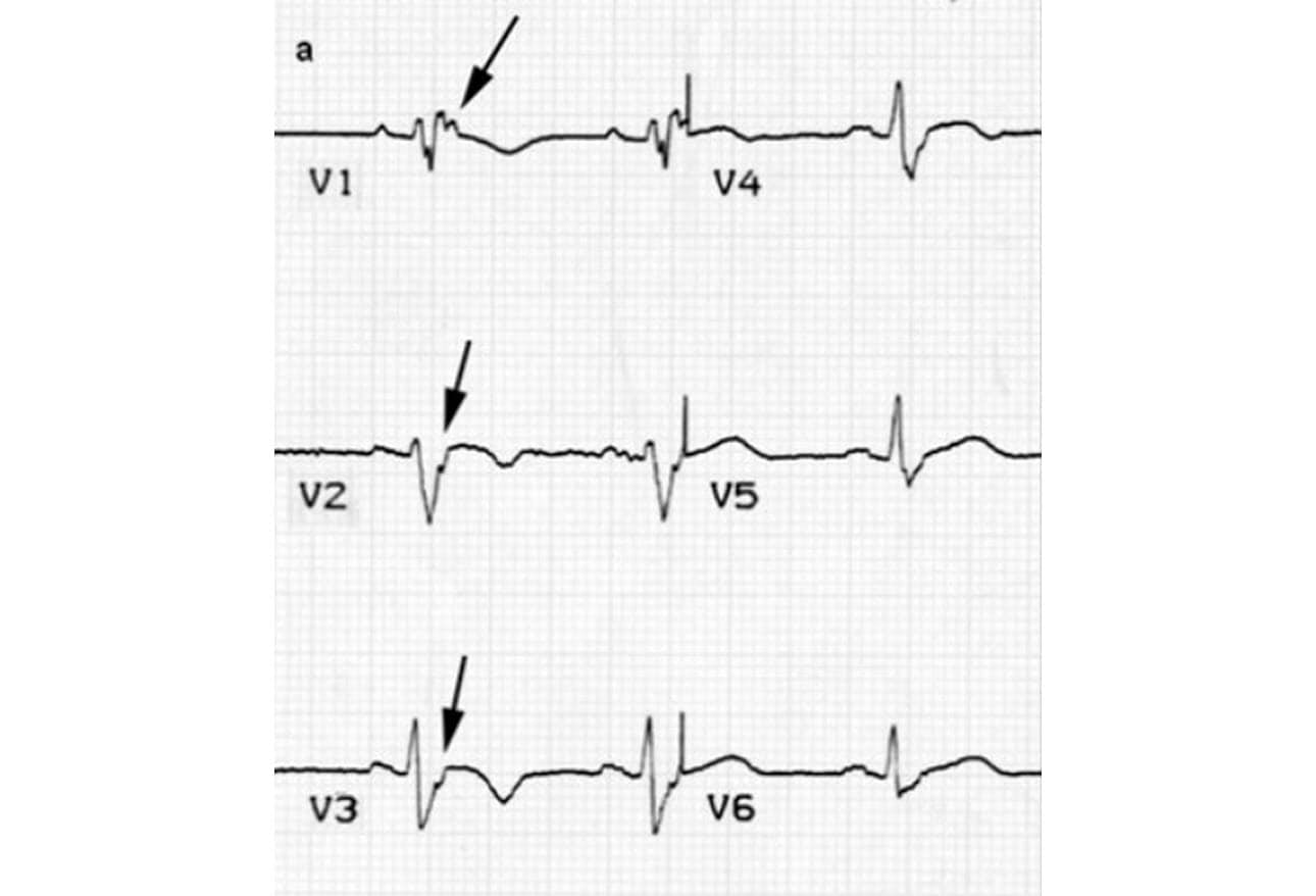 Sudden Cardiac Death in Athletes