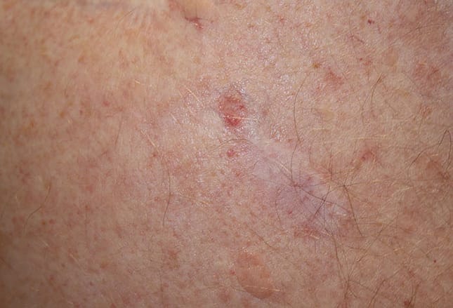 Sun and Skin: From Burns to Melanoma, What Every Clinician Needs to ...