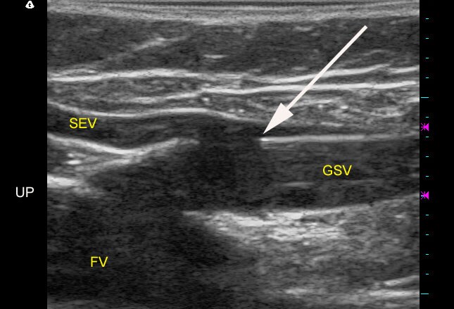 Superficial Venous Insufficiency: Varicose Veins and Venous Ulcers