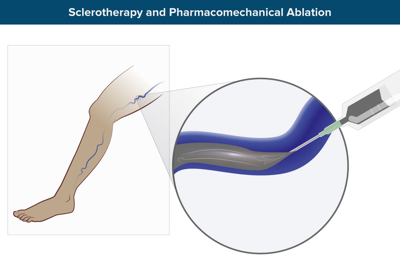 Superficial Venous Insufficiency: Varicose Veins and Venous Ulcers