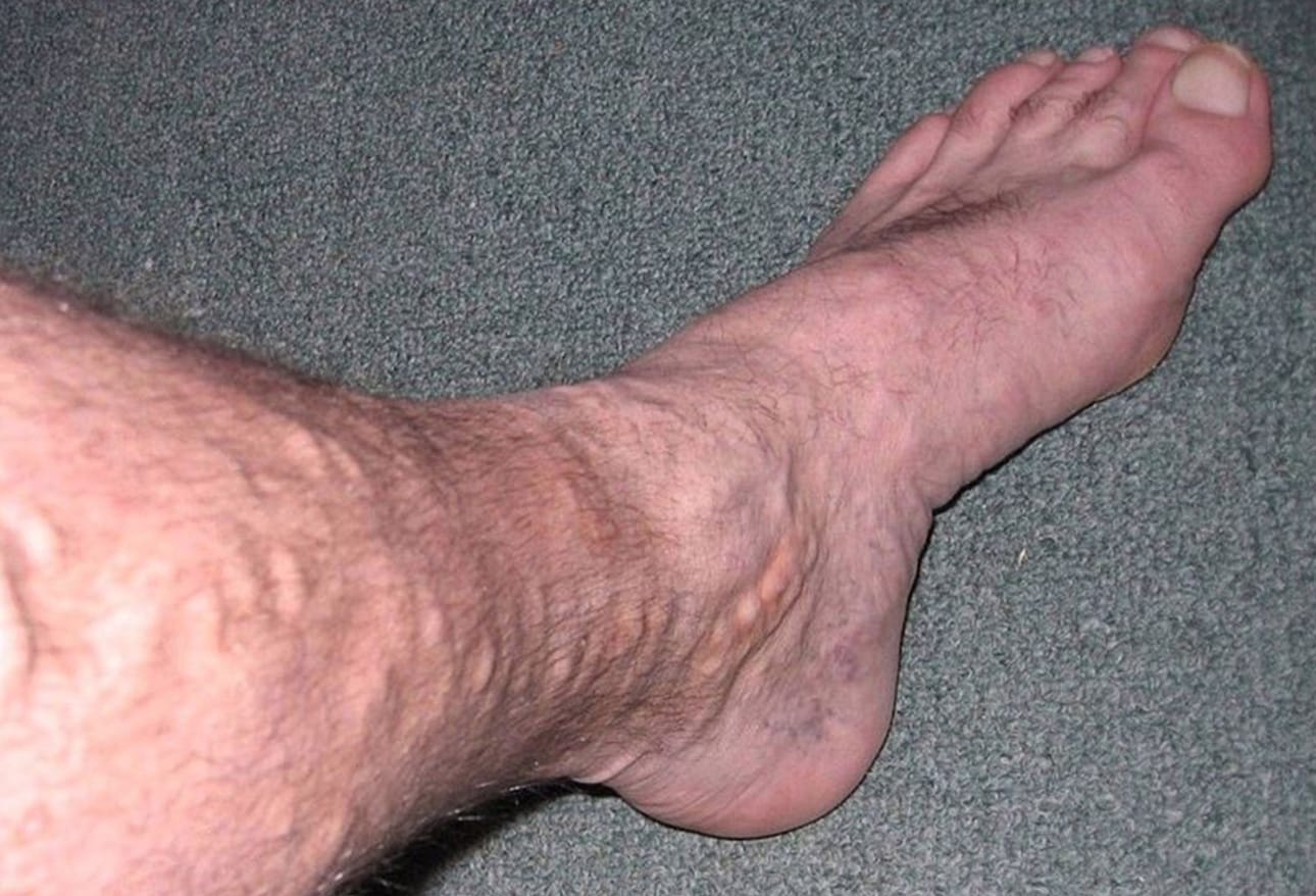 Superficial Venous Insufficiency: Varicose Veins and Venous Ulcers