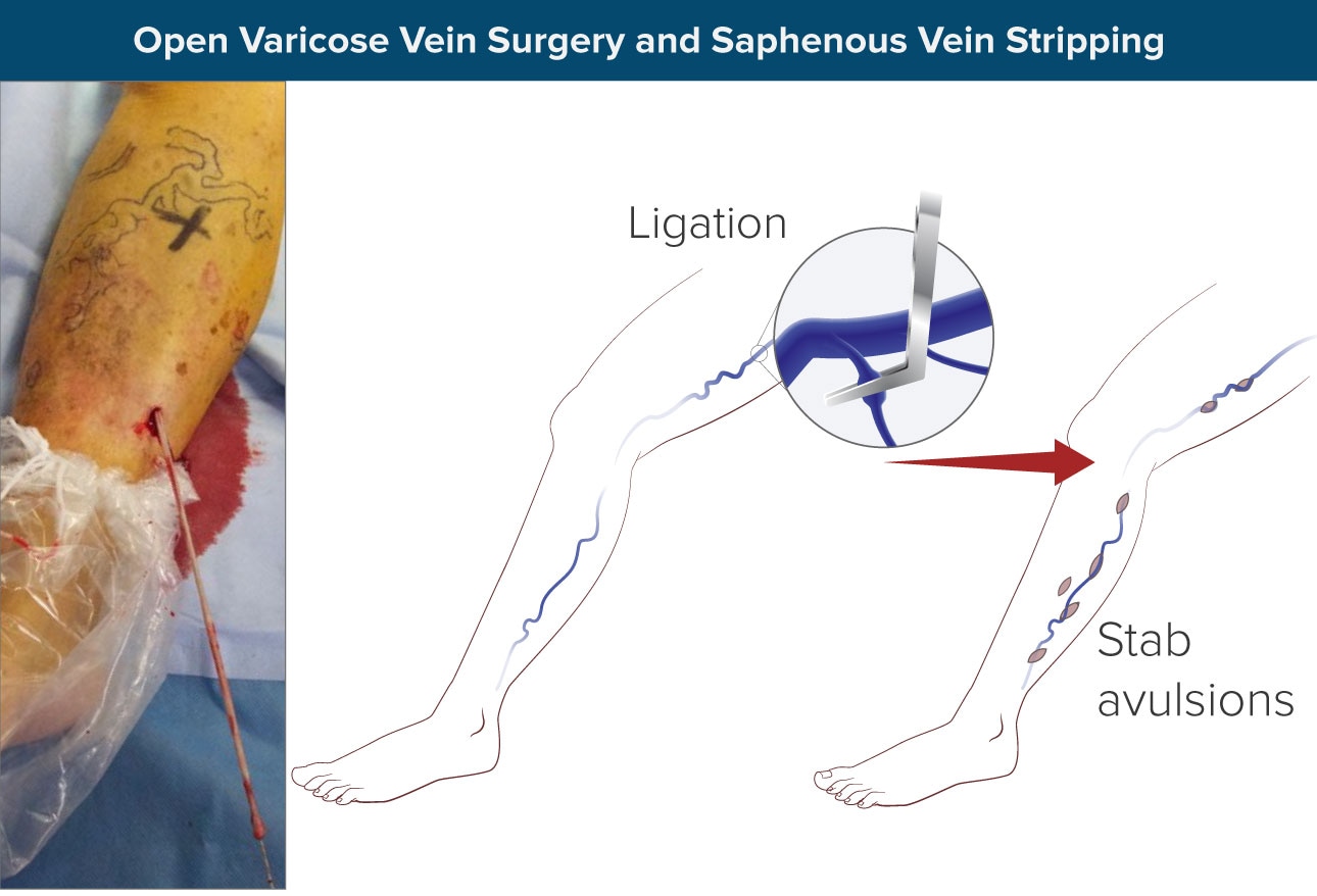 Superficial Venous Insufficiency: Varicose Veins and Venous Ulcers