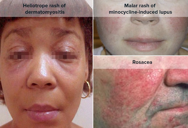 Systemic Lupus Erythematosus: Diverse and Difficult to Diagnose Systemic Lupus Erythematosus: Diverse and Difficult to Diagnose