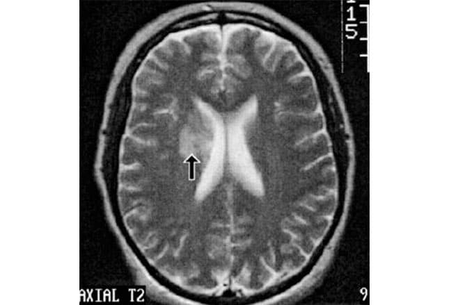 Systemic Lupus Erythematosus: Diverse and Difficult to Diagnose Systemic Lupus Erythematosus: Diverse and Difficult to Diagnose