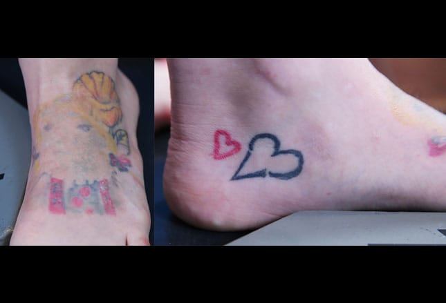 Tattoo Skin Reactions: Allergies and Infections