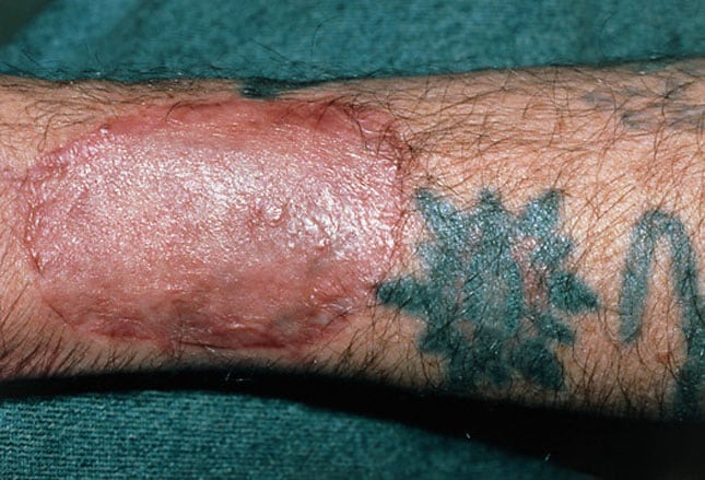 Tattoo Skin Reactions: Allergies and Infections