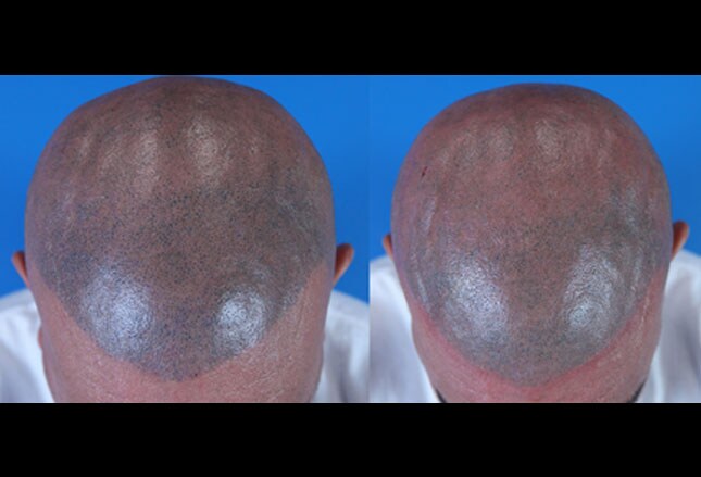 Tattoo Skin Reactions: Allergies and Infections