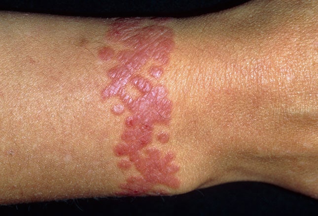 Tattoo Skin Reactions: Allergies and Infections