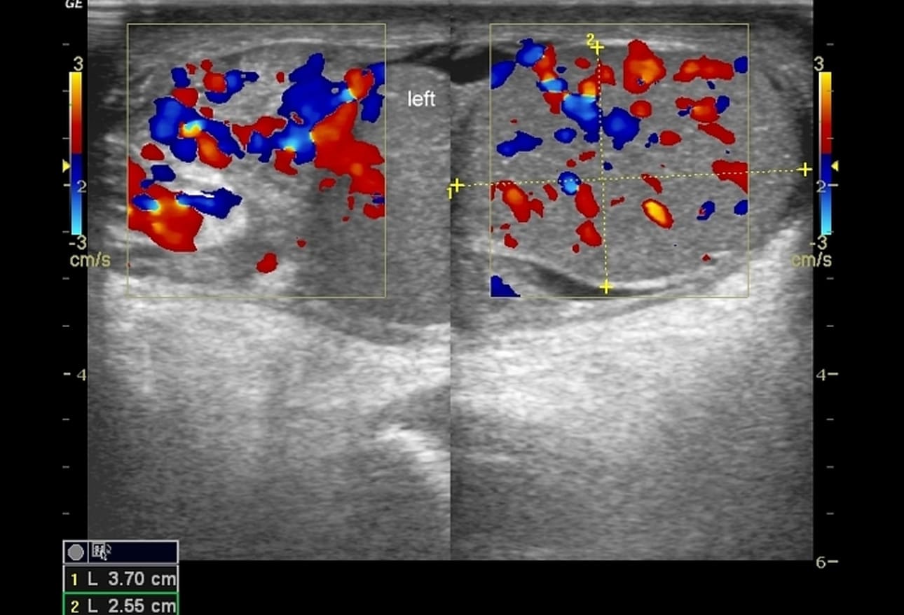 Testicular Disorders: Trouble Doesn’t Always Come in Pairs