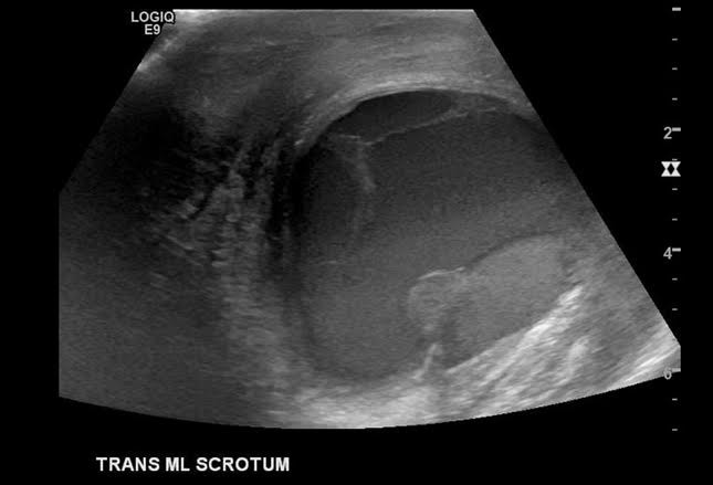 Testicular Disorders: Trouble Doesn’t Always Come in Pairs