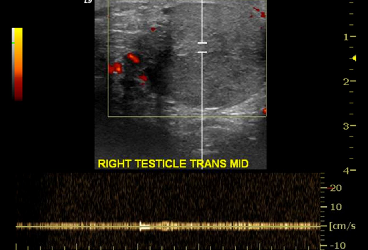 Testicular Disorders: Trouble Doesn’t Always Come in Pairs