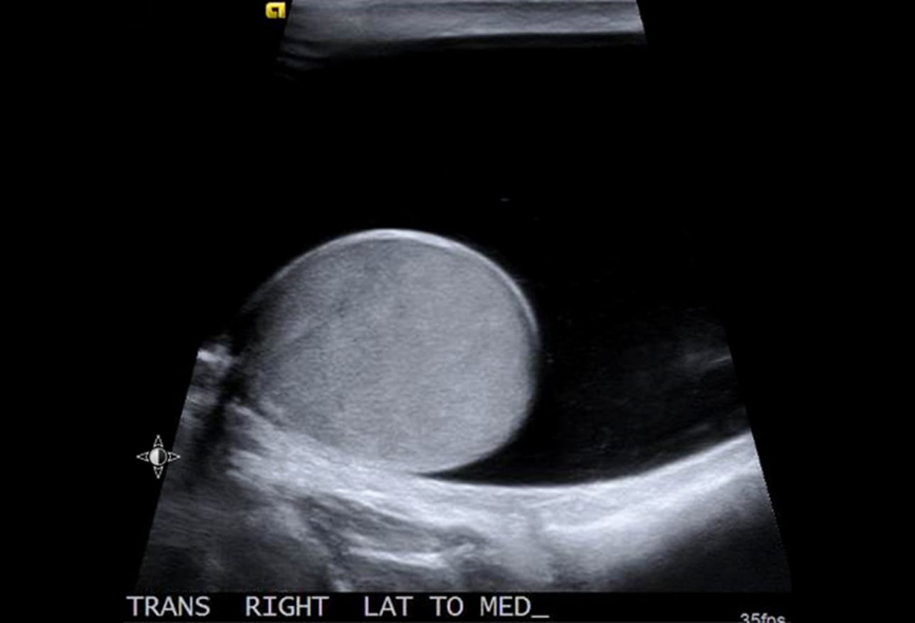 Testicular Disorders: Trouble Doesn’t Always Come in Pairs