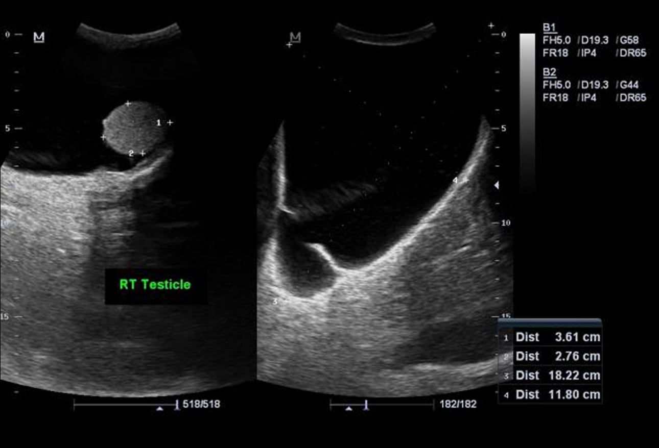 Testicular Disorders: Trouble Doesn’t Always Come in Pairs