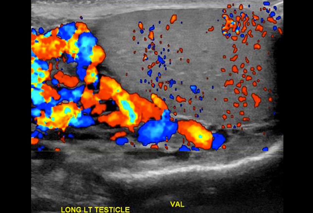 Testicular Disorders: Trouble Doesn’t Always Come in Pairs