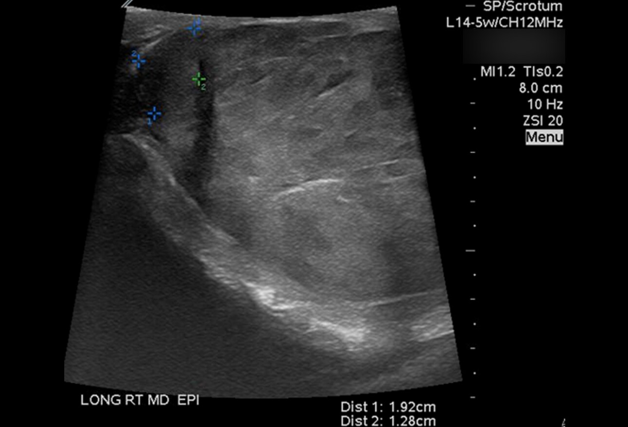 Testicular Disorders: Trouble Doesn’t Always Come in Pairs