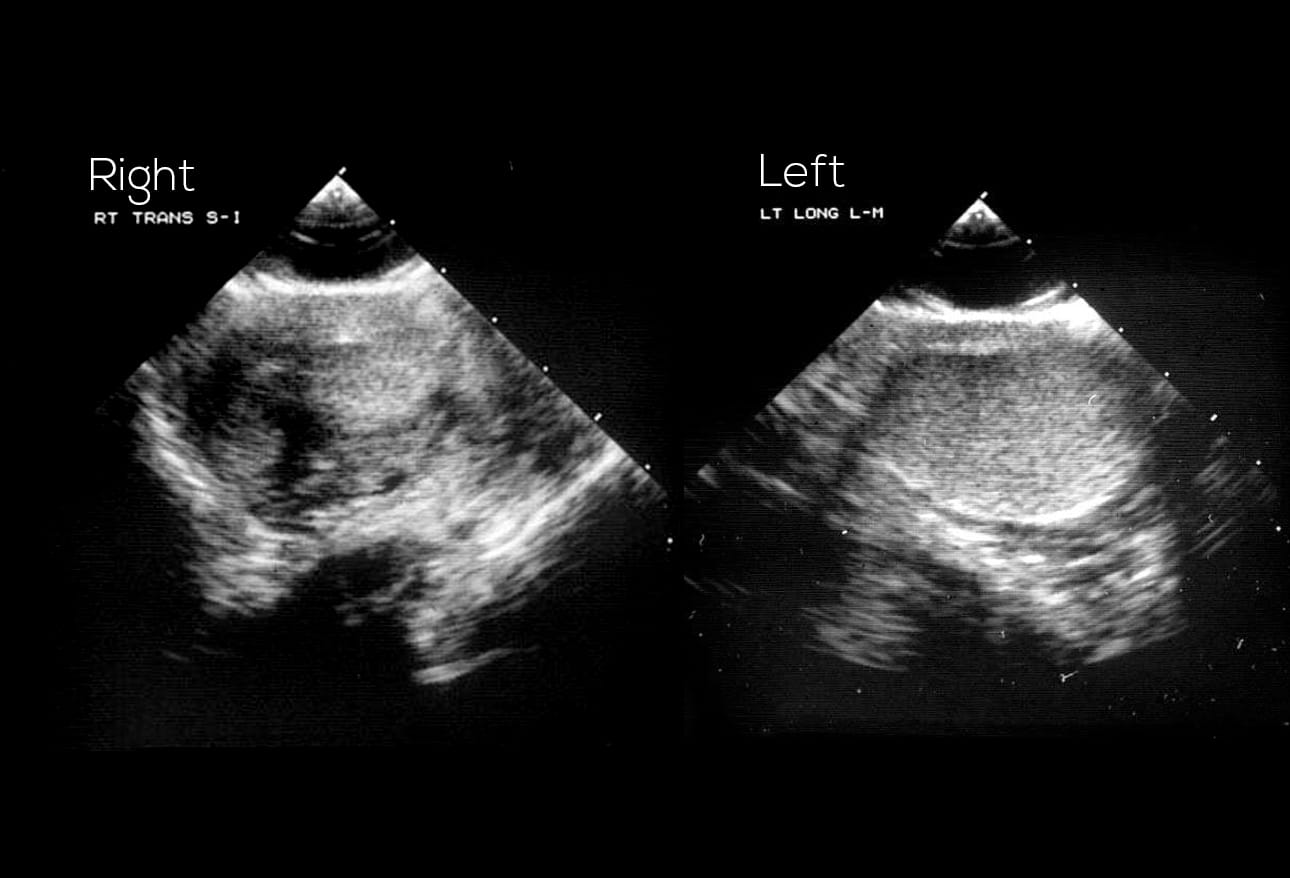 Testicular Disorders Trouble Doesn T Always Come In Pairs