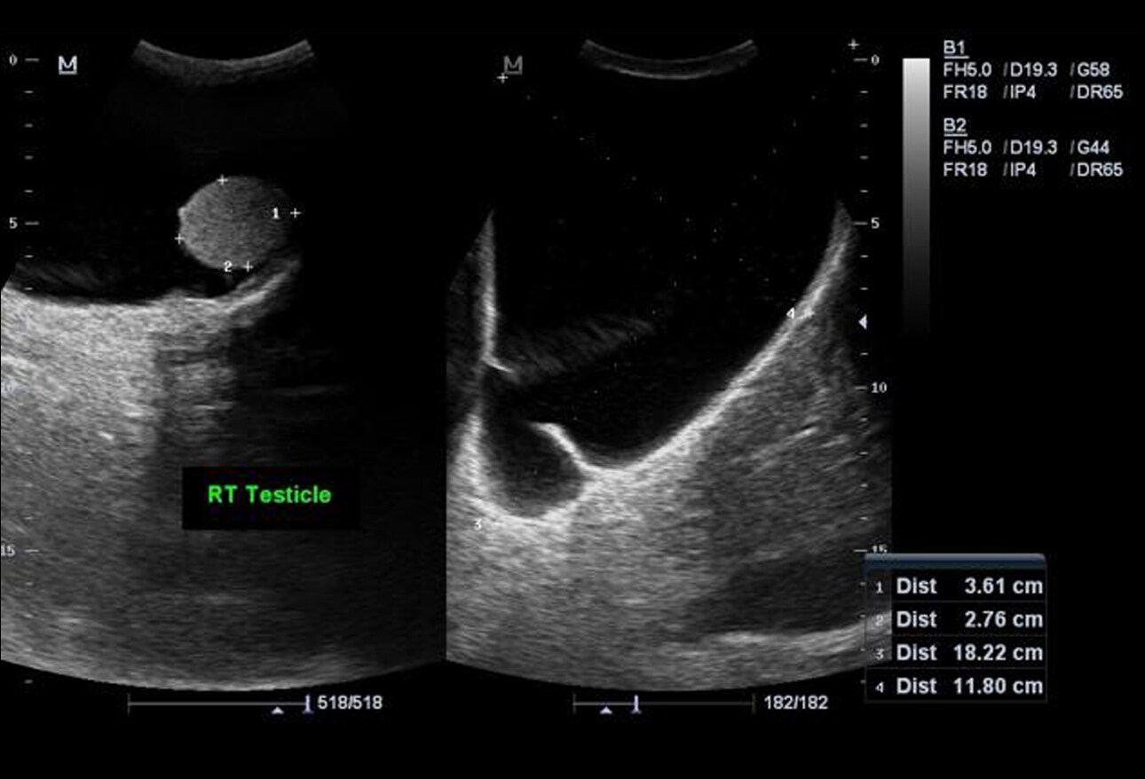 Testicular Disorders: Trouble Doesn’t Always Come in Pairs