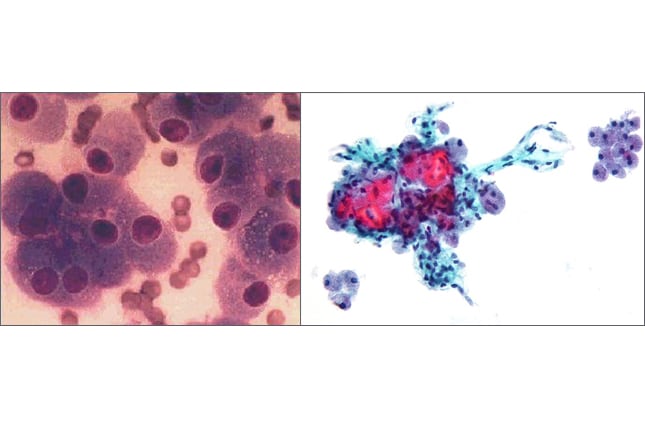 A Lump in the Throat: Thyroid Cancer