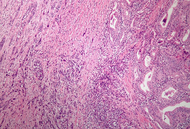 A Lump in the Throat: Thyroid Cancer