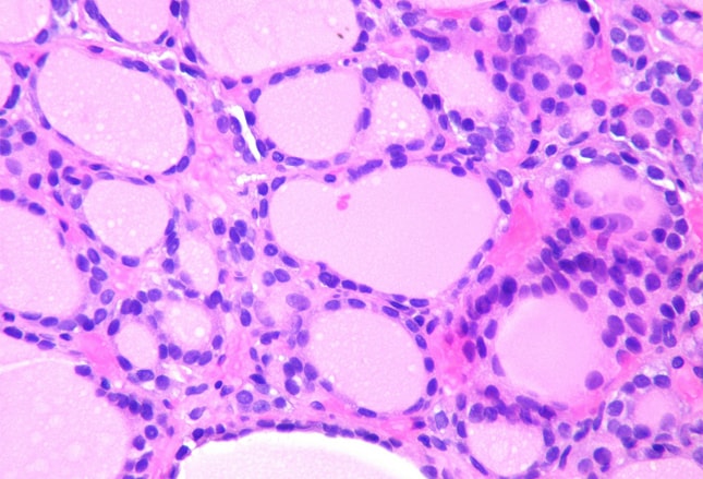 A Lump in the Throat: Thyroid Cancer