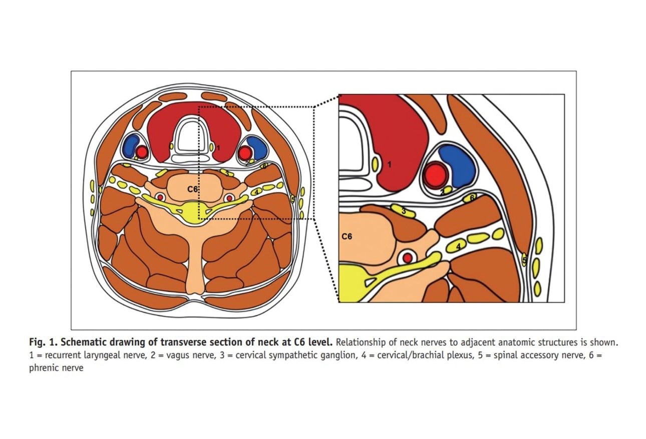 Shrinking Thyroid Nodules with Radiofrequency Ablation