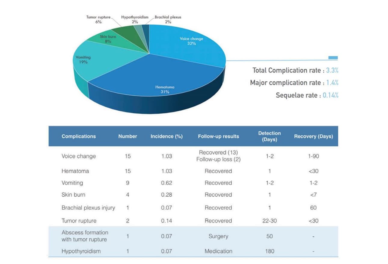 Shrinking Thyroid Nodules with Radiofrequency Ablation