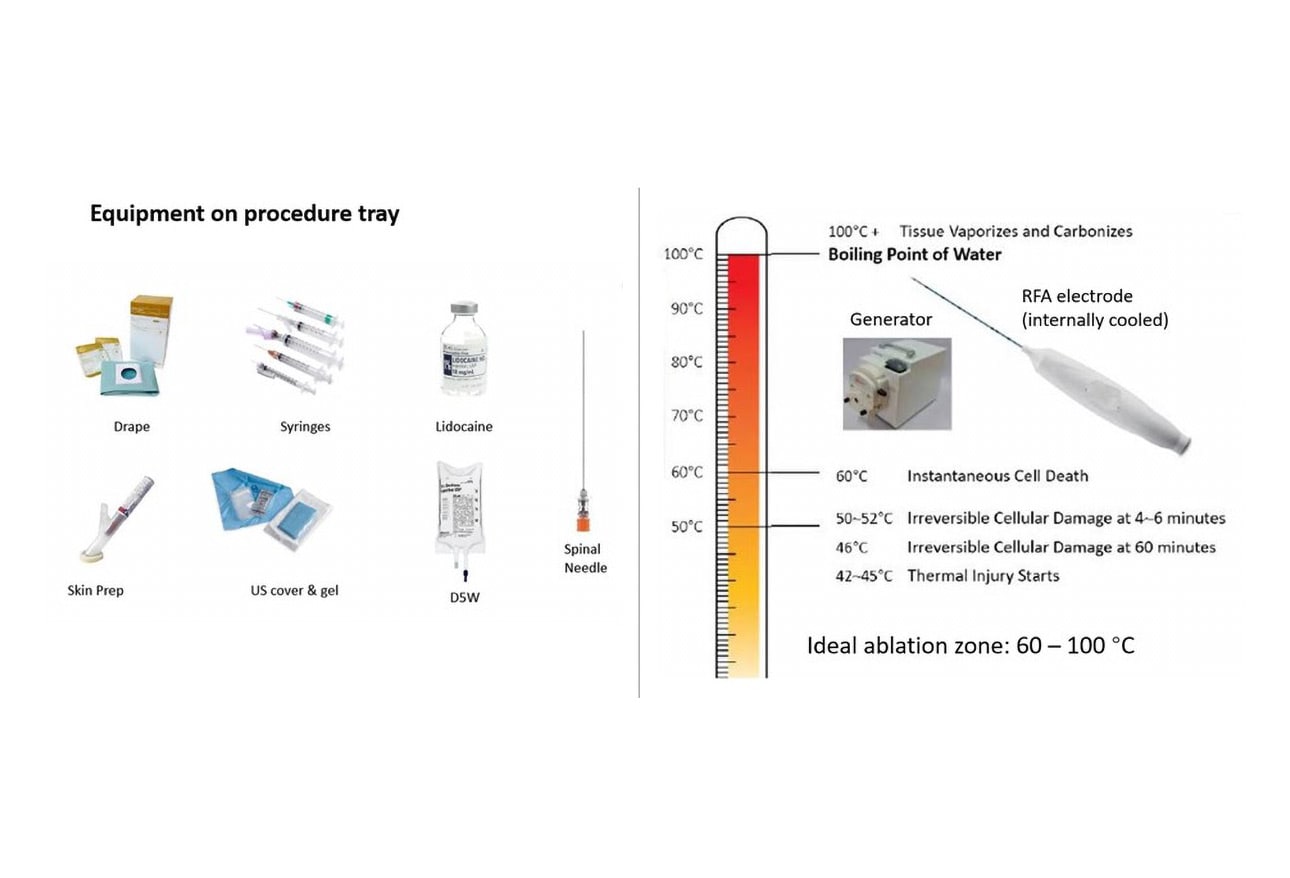 Shrinking Thyroid Nodules with Radiofrequency Ablation