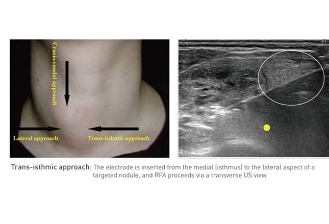 Shrinking Thyroid Nodules with Radiofrequency Ablation