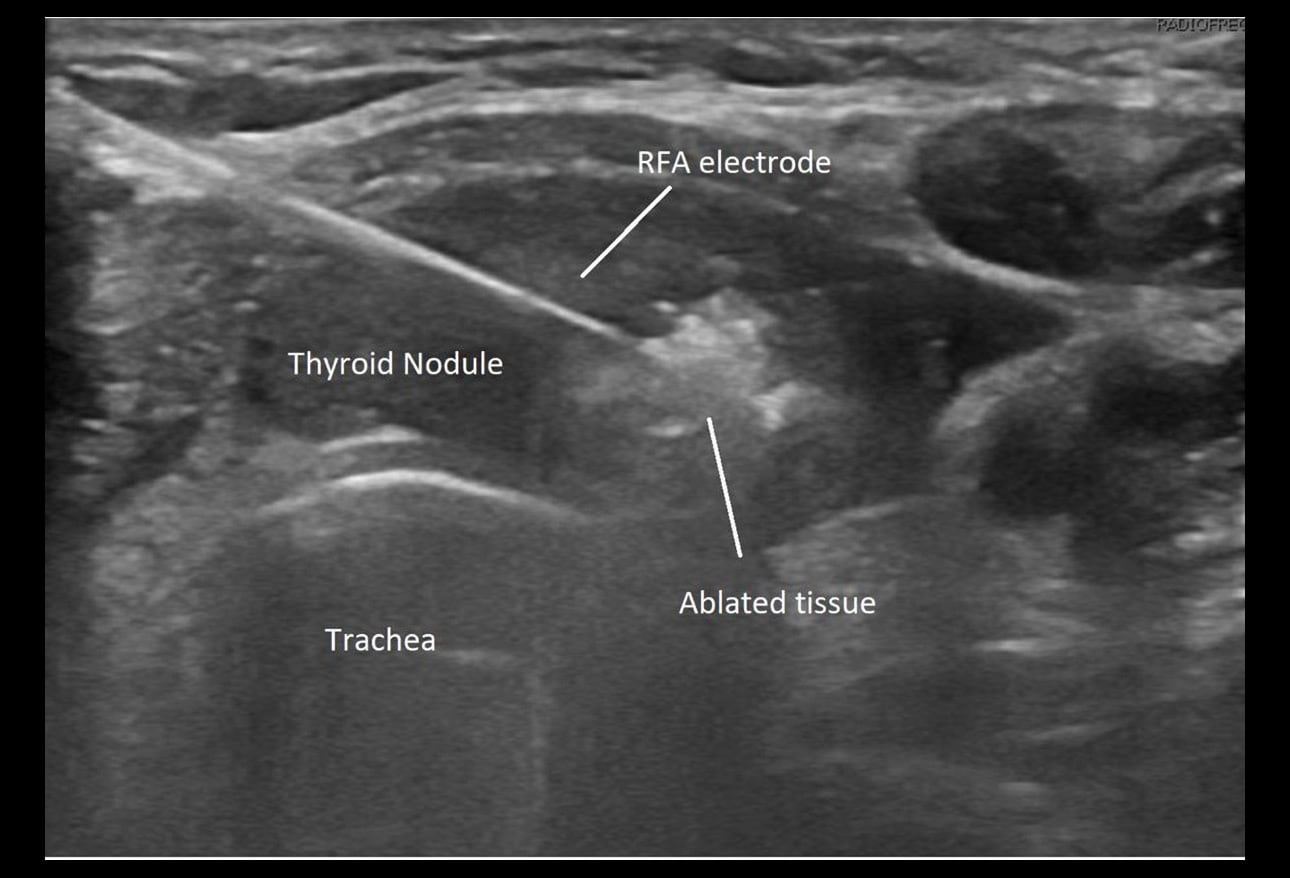 Shrinking Thyroid Nodules with Radiofrequency Ablation