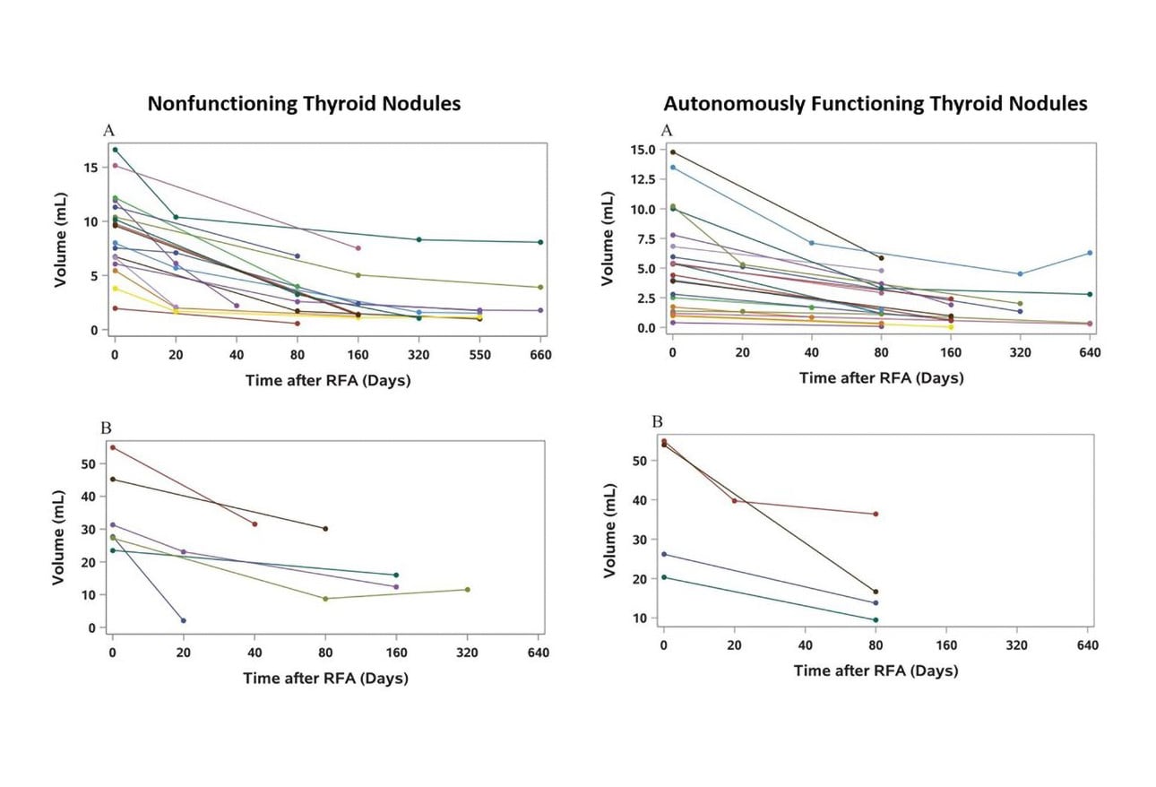 Shrinking Thyroid Nodules with Radiofrequency Ablation